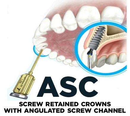 Angulated Screw Channel